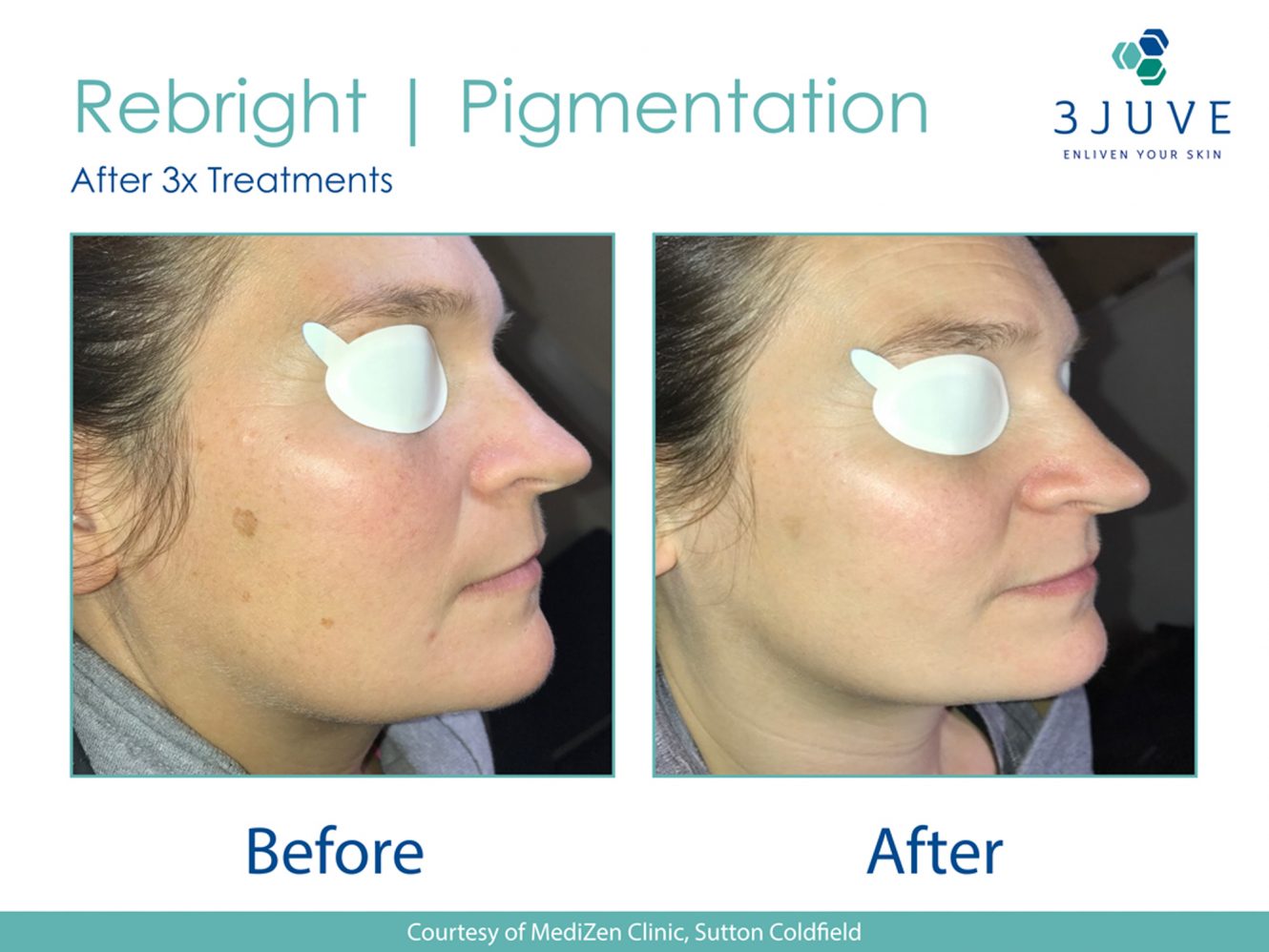 Skin Rejuvenation Machines • Anti-Aging Technology • Lynton Lasers