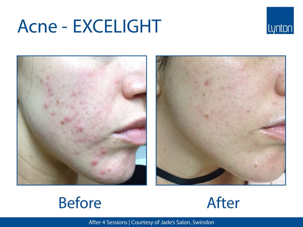 Acne Treatment Machines • Laser & IPL Acne Treatment : Lynton
