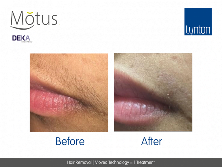 Professional Hair Removal Machines Laser & IPL • Lynton Lasers