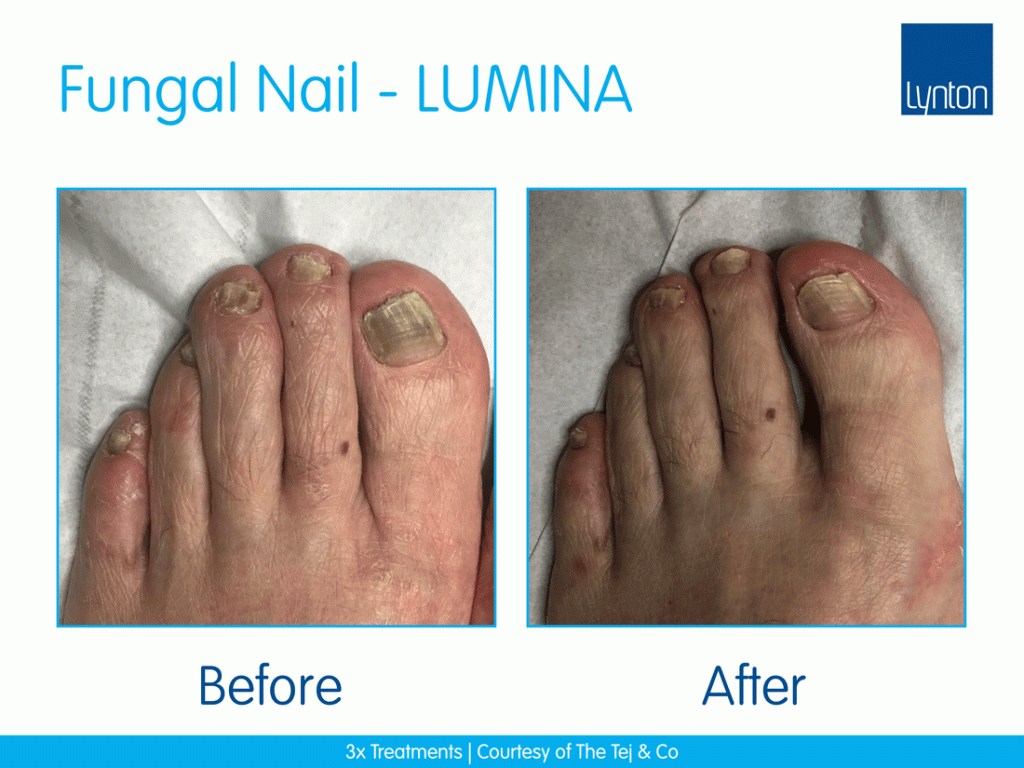 Laser Treatment Machines for Nail Fungus or Fungal Nail • Lynton Lasers