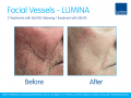 LUMINA • Professional Laser and IPL Machine • Lynton Lasers