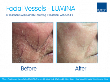 LUMINA • Professional Laser and IPL Machine • Lynton Lasers