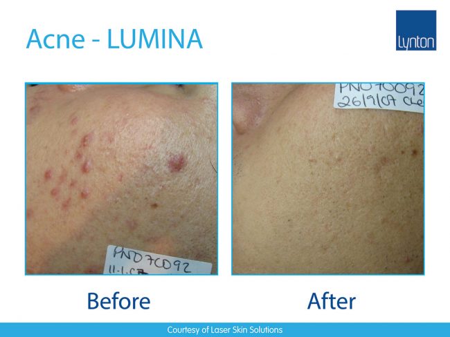 Acne Treatment Machines • Laser & IPL Acne Treatment : Lynton