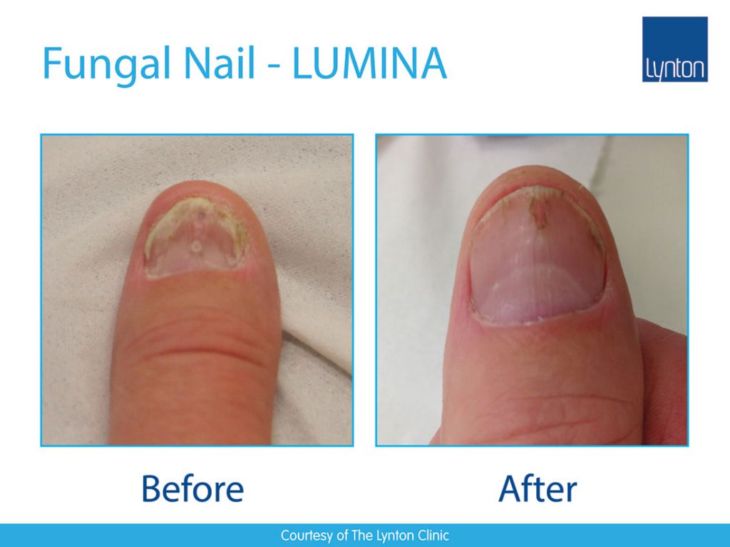 Laser Treatment Machines for Nail Fungus or Fungal Nail • Lynton Lasers
