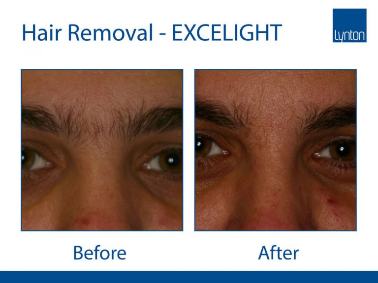 Professional Hair Removal Machines Laser & IPL • Lynton Lasers