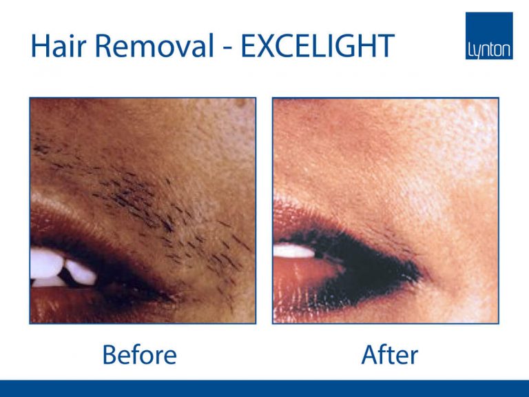 Professional Hair Removal Machines Laser & IPL • Lynton Lasers