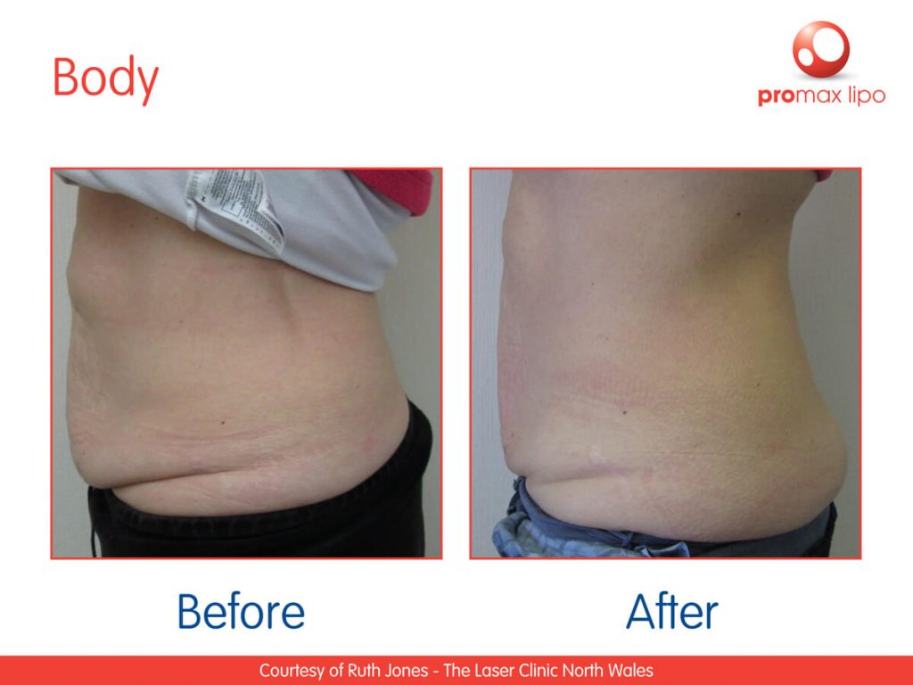 ProMax LIPO - Non-Surgical Liposuction Machine • Lynton Lasers