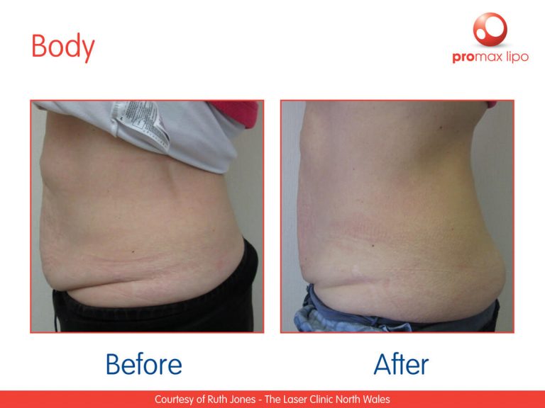 ProMax LIPO - Non-Surgical Liposuction Machine • Lynton Lasers