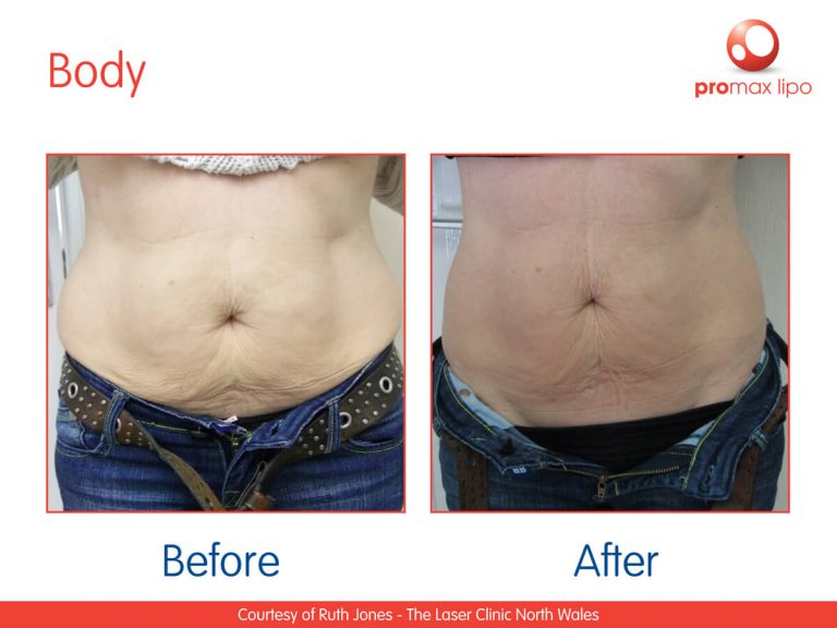 ProMax LIPO - Non-Surgical Liposuction Machine • Lynton Lasers