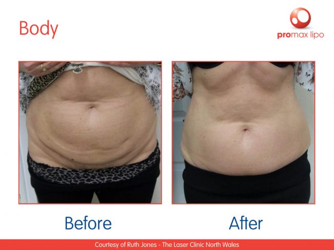 ProMax LIPO - Non-Surgical Liposuction Machine • Lynton Lasers