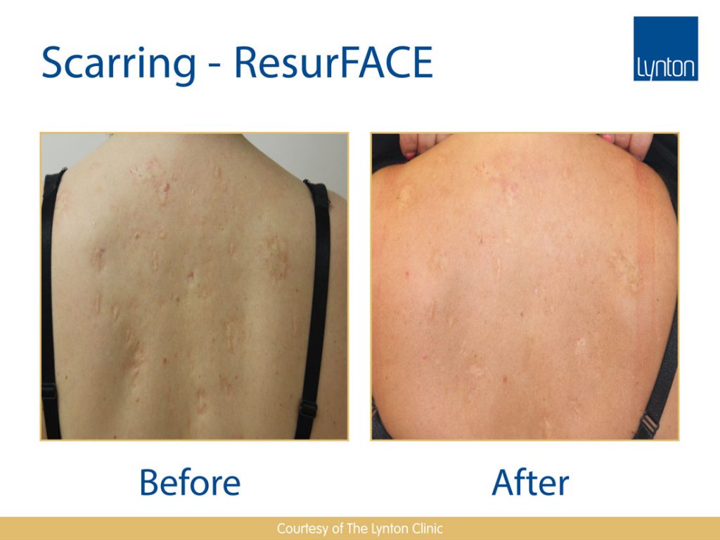 Laser Treatment for Scars Guide • Lynton Lasers
