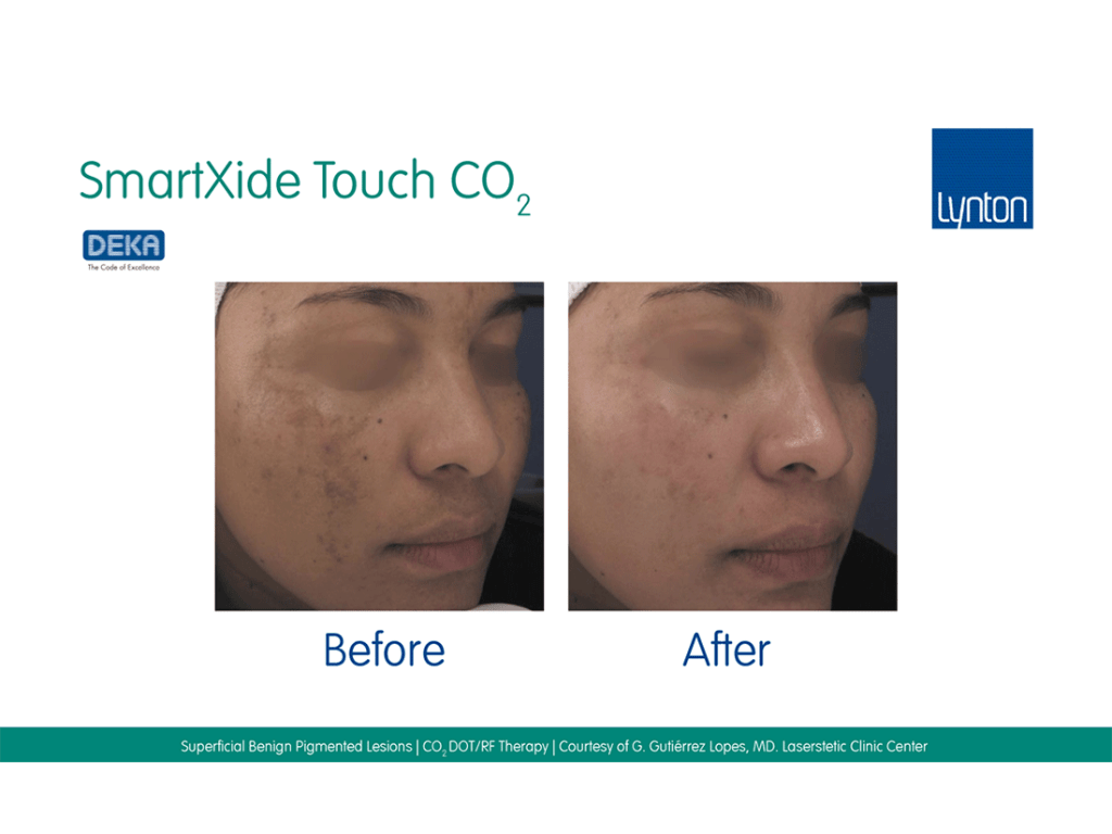 Skin Rejuvenation Machines for Aesthetic Clinics • Lynton Lasers