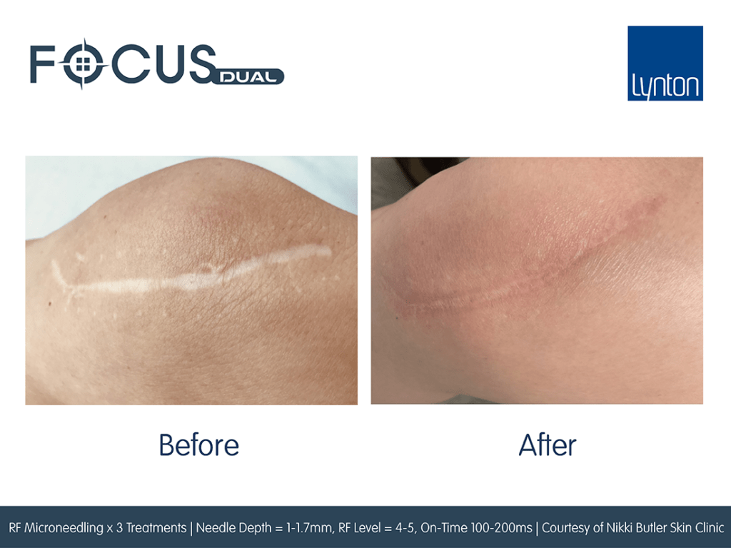 Everything You Need To Know About Focus Dual® • Lynton