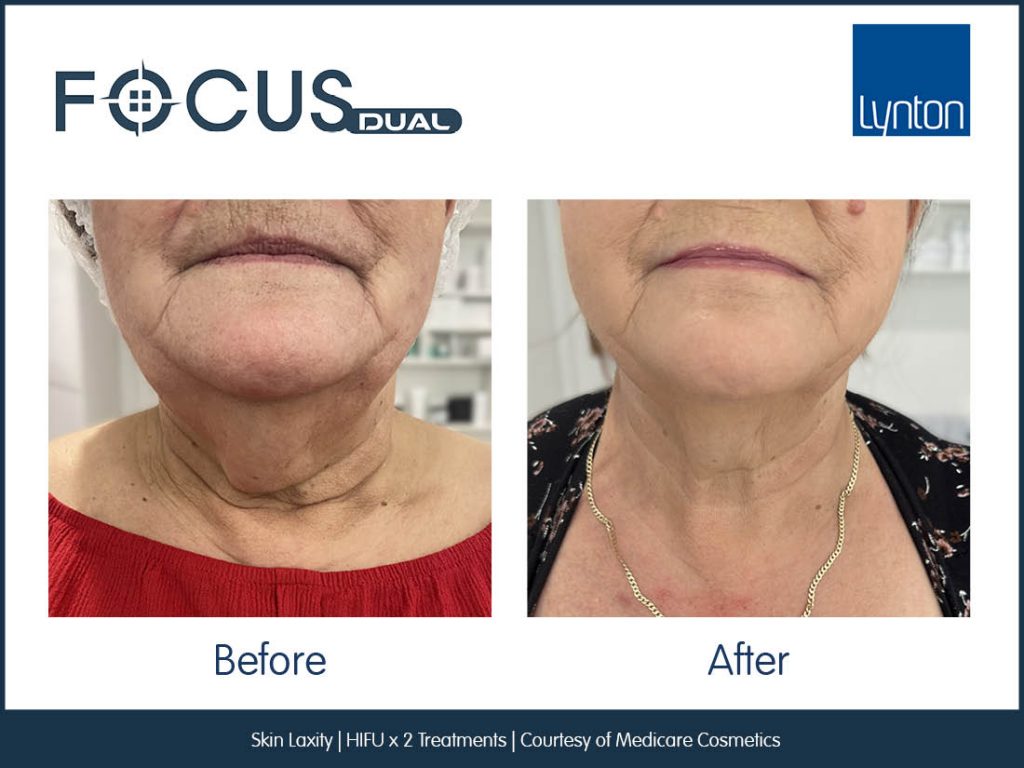 RF Microneedling Machine • Focus Dual • Lynton Lasers