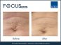 RF Microneedling Machine • Focus Dual • Lynton Lasers