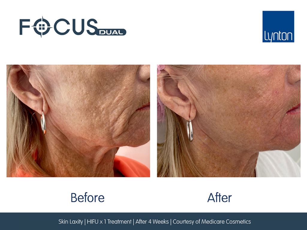 Everything You Need To Know About Focus Dual® • Lynton