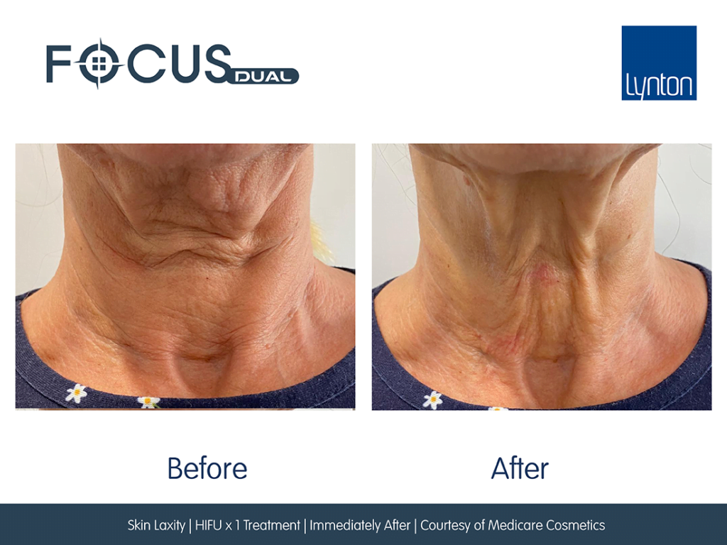 Everything You Need To Know About Focus Dual® • Lynton