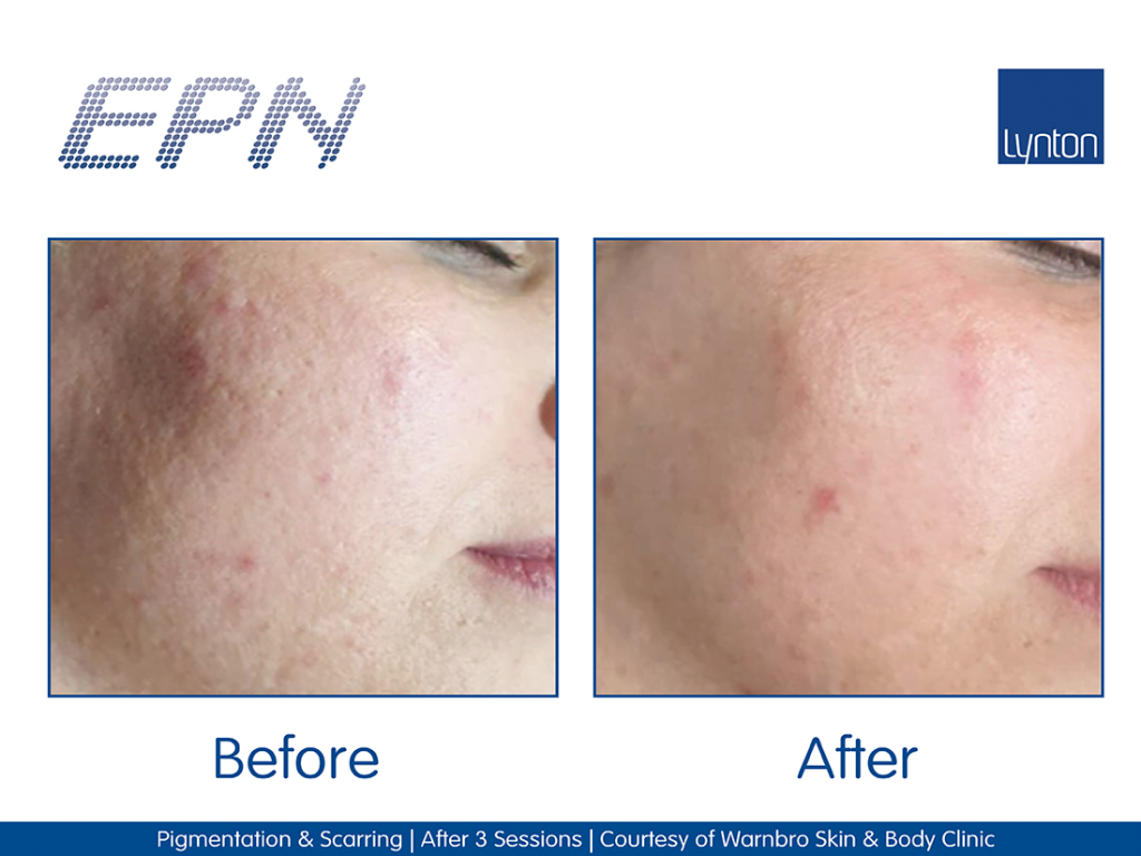 Professional Microneedling Pen with Electroporation • EPN Pen • Lynton