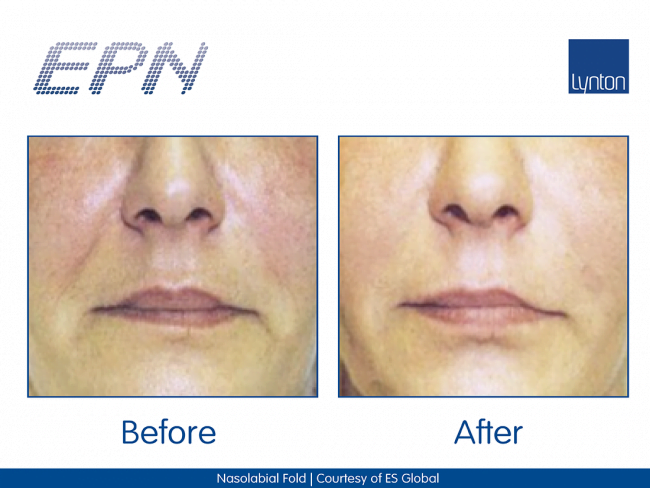 Professional Microneedling Pen with Electroporation • EPN Pen • Lynton