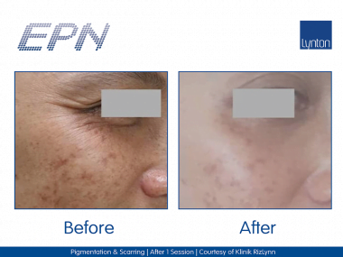 Professional Microneedling Pen with Electroporation • EPN Pen • Lynton