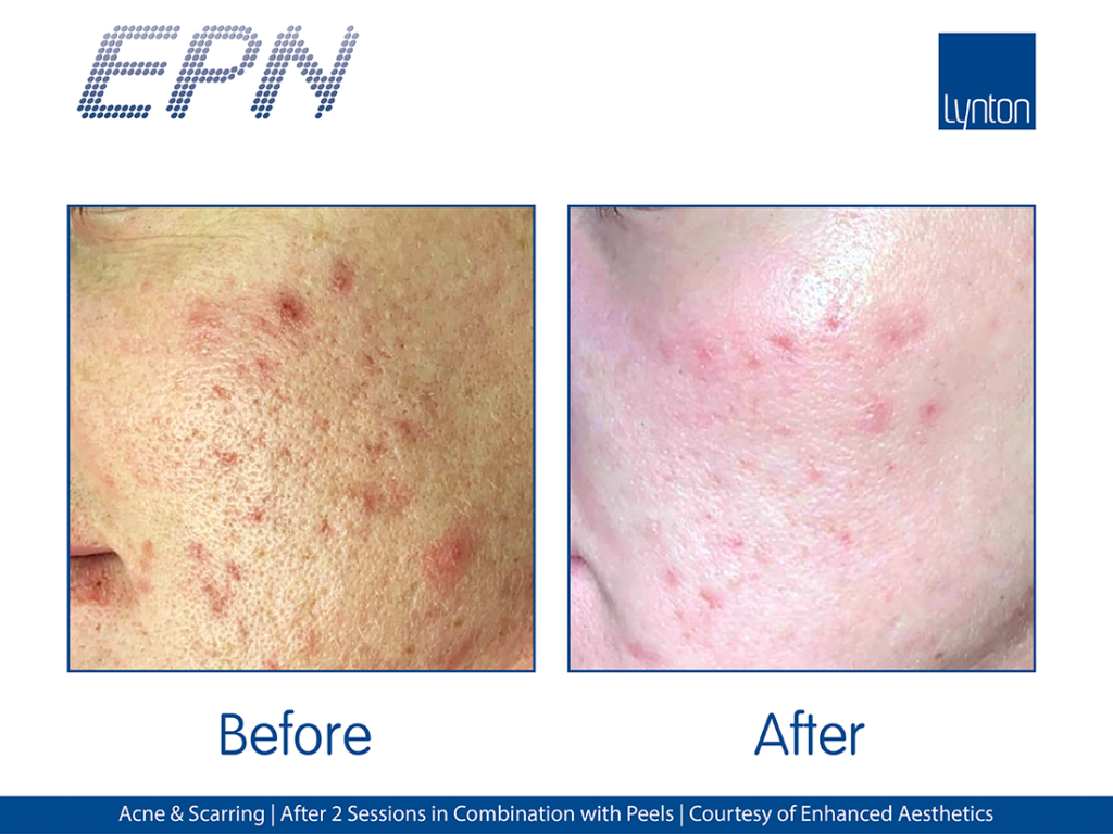 Professional Microneedling Pen with Electroporation • EPN Pen • Lynton