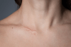 Laser Treatment for Scars Guide • Lynton Lasers