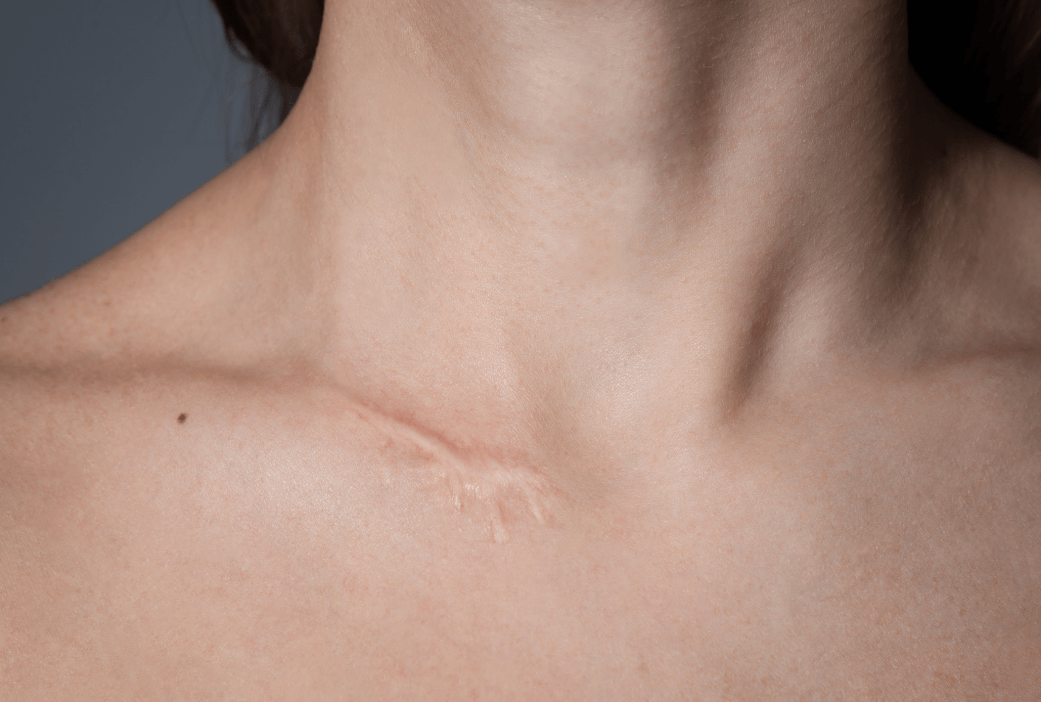 Laser Treatment for Scars Guide • Lynton Lasers
