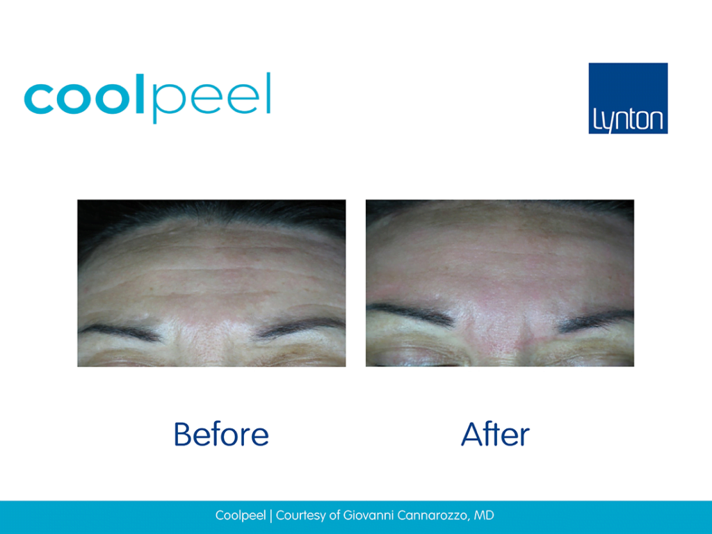 CoolPeel Treatment • Lynton Lasers