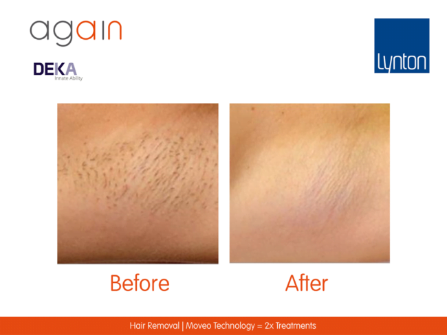 AGAIN • Deka Laser Aesthetics Equipment • Lynton Lasers