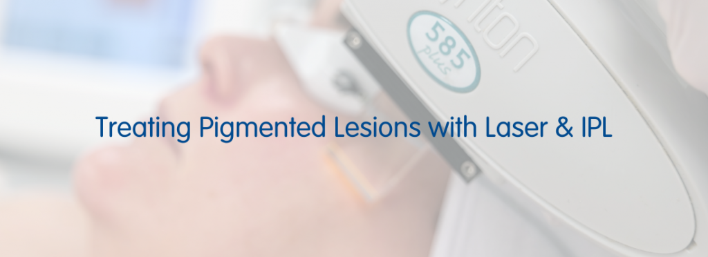 Treating Pigmentation with Laser & IPL • Lynton