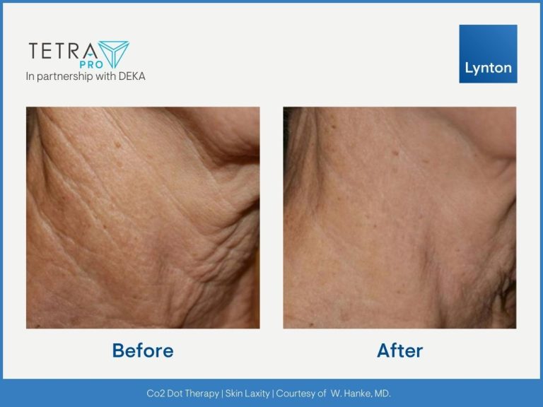 Tetra Pro SmartXide CO₂ Laser Skin Resurfacing Machine by Deka