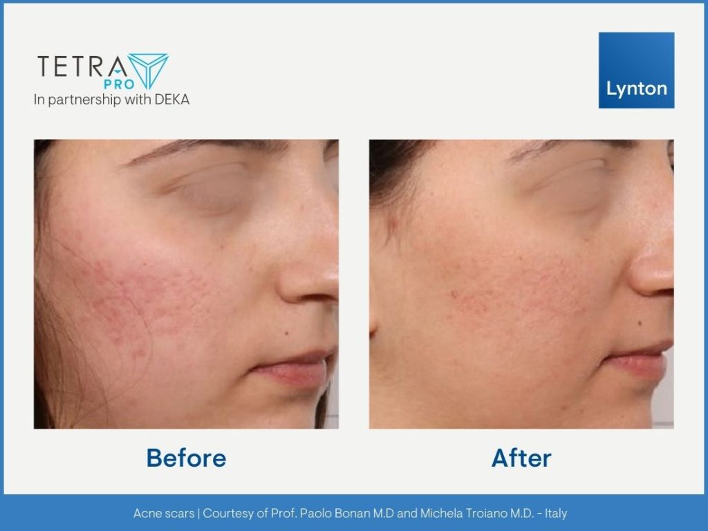 Tetra Pro SmartXide CO₂ Laser Skin Resurfacing Machine by Deka