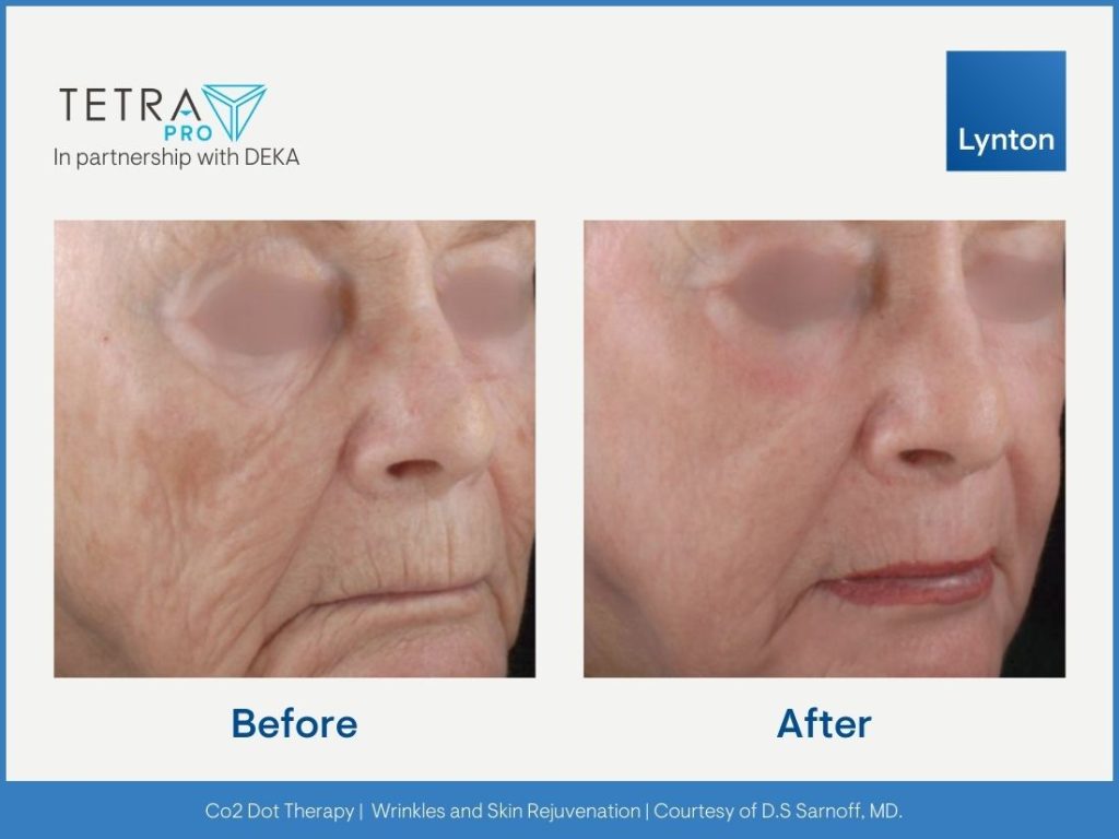 Tetra Pro SmartXide CO₂ Laser Skin Resurfacing Machine by Deka